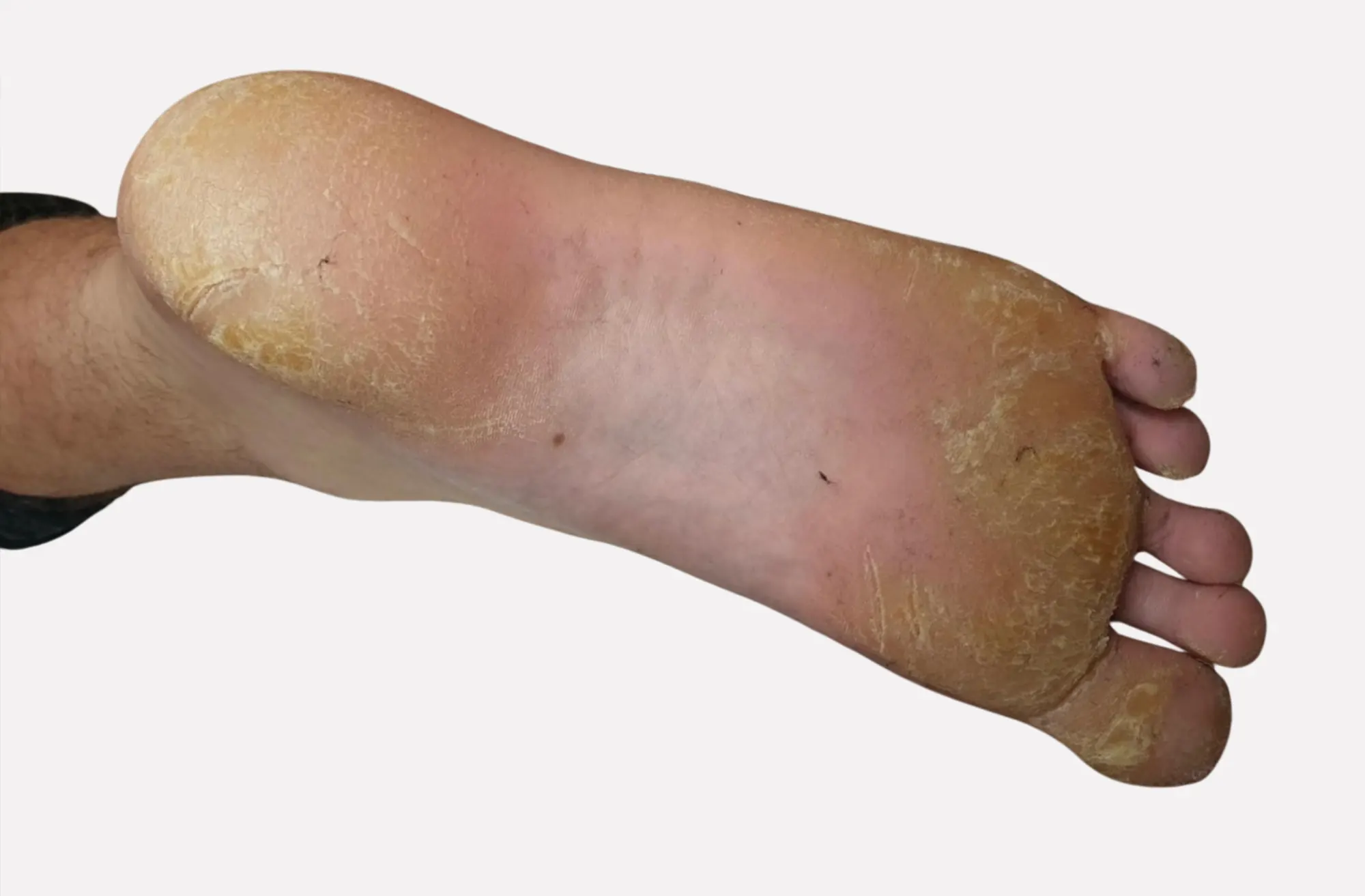 Îndepărtarea stratului de hiperkeratoză (piele îngroșată) - Pedichiură ...