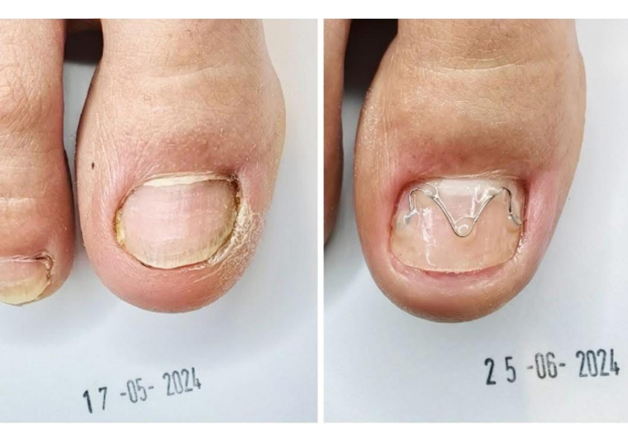 Rolul protezei Unibrace în tratarea unghiei încarnate fără intervenție ...
